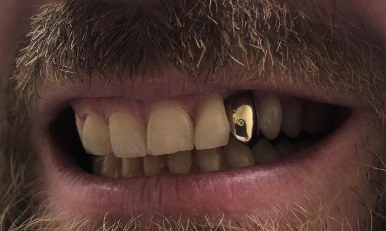 Medina Tooth Implants | Before and After Photos